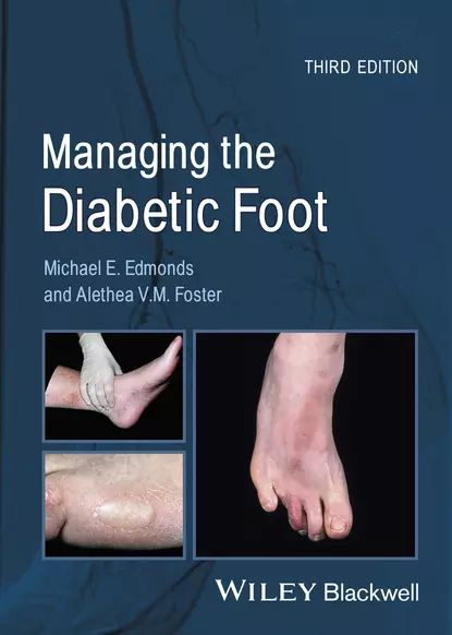 Managing the Diabetic Foot | Alethea Foster V.M., Michael Edmonds E ...