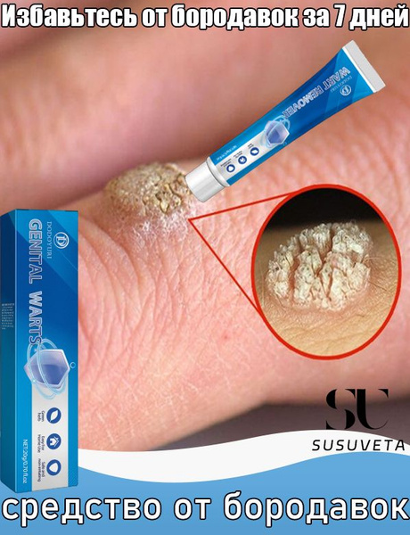 DODOYURI Крем для лечения папиллом и бородавок, эффективно лечит ...