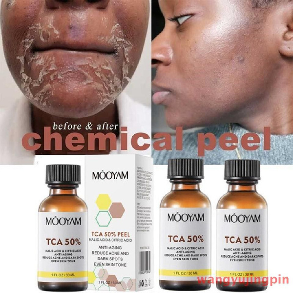Химический пилинг TCA 50%, 7 дней Супер сильный кислотный пилинг кожи Tca, пигментация, шрамы от ...
