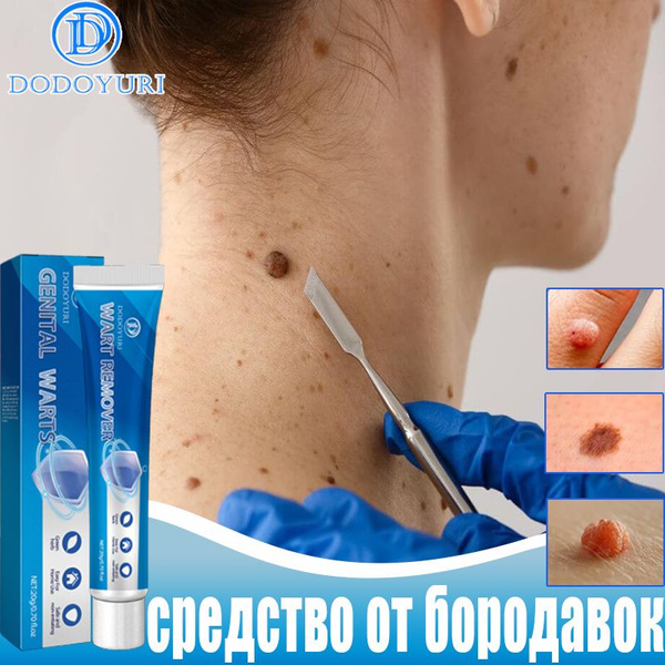 DODOYURI мазь от папиллом и бородавок, без рубцов и боли, для лечения ...
