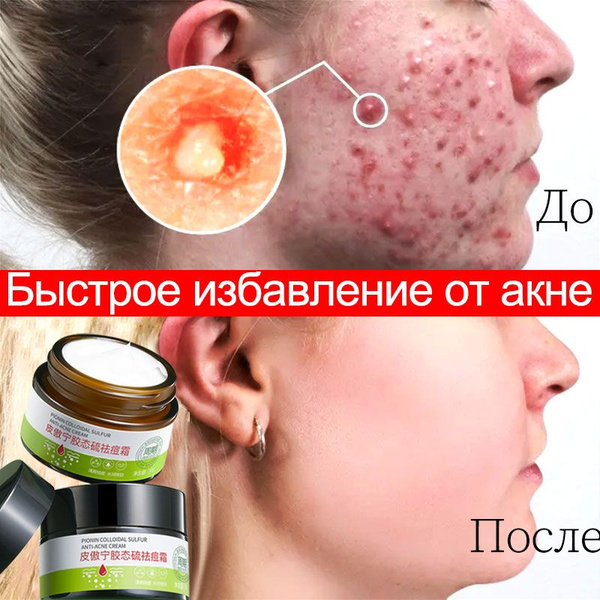 Крем для лица от акне прыщей, Содержит салициловую кислоту, азелаиновую ...