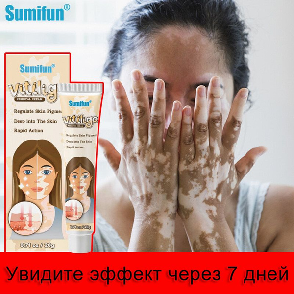 Средство при нежелательной пигментации витилиго,Мазь для лечения белых ...