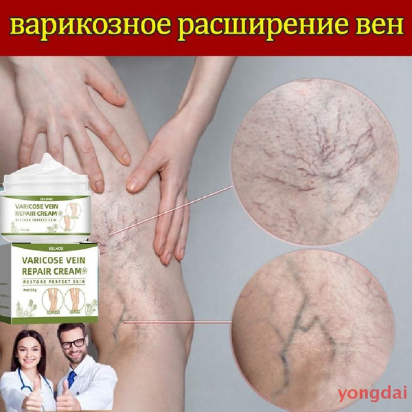 Крем для лечения варикозного расширения вен, Эффективен при лечении ...