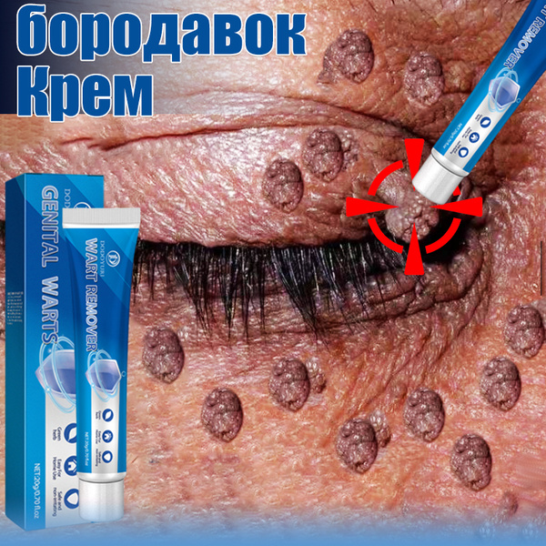 DODOYURI Крем для удаления бородавок и родинок 20g от папиллом и ...