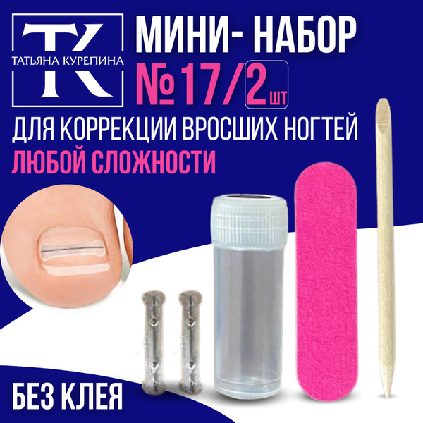 Мини-набор N 17/2 для коррекции вросших ногтей любой сложности / без ...