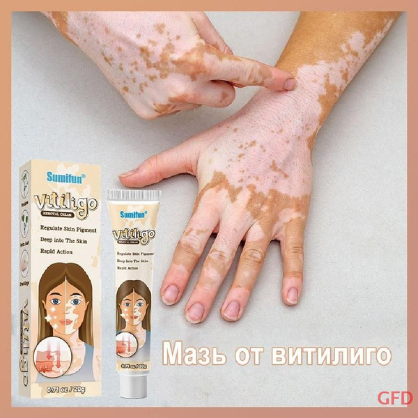 Мазь от витилиго Средство при нежелательной пигментации витилиго Мазь для лечения белых пятен на