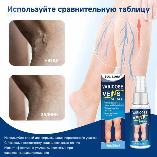 SOL LORA Спрей от варикоза лечение 30 мл Эффективен при лечении варикозного расширения вен ...