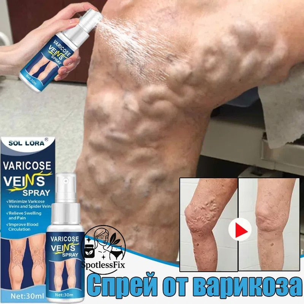 SOL LORA Спрей от варикоза, усталости и отека ног 30ml Эффективно лечит отек и боль в ногах ...