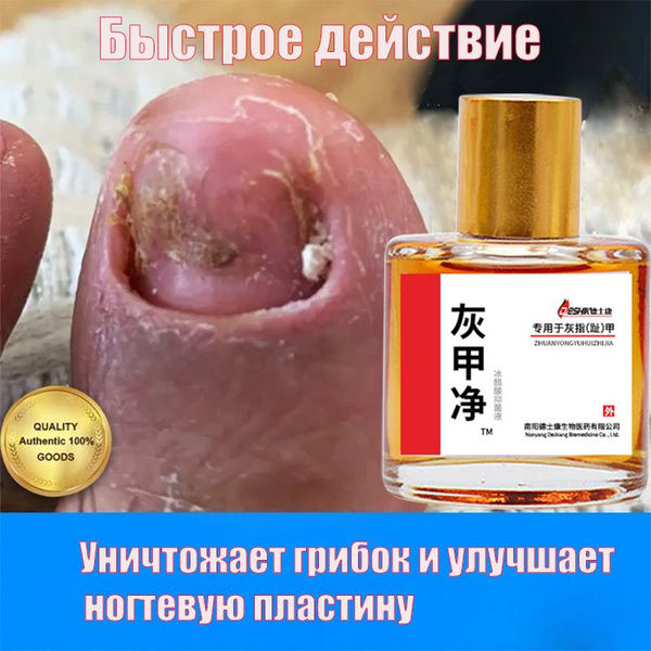 профилактика и лечение от грибка онихомикоза на руках и ногах, при ...