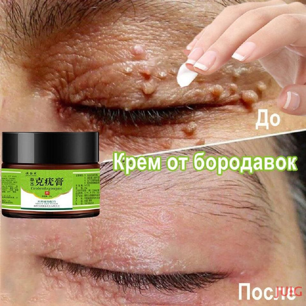 Крем для удаления бородавок и родинок 20g от папиллом и бородавок на ...