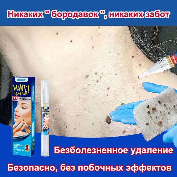 Характеристики гелевая ручка для удаления бородавок родинок и папиллом ...