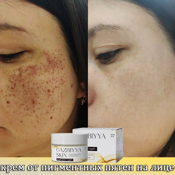 крем от пигментных пятен на лице крем отбеливающий от пигментации для лица 30 г с Витаминами С и