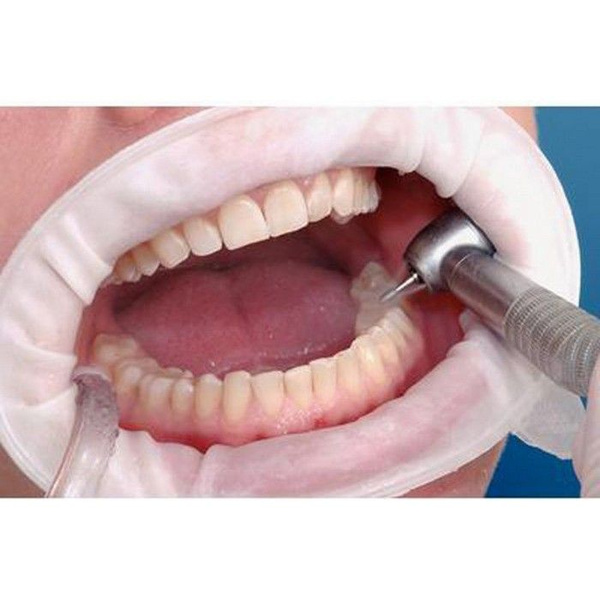 Роторасширитель Ivoclar Vivadent OptraGate Small (ОптраГейт) 1 шт ...