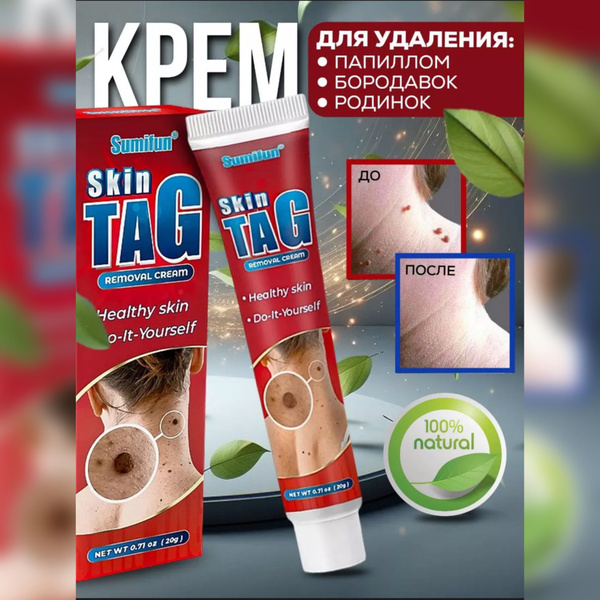 Крем для удаления Постакне,Папиллом,Бородавок,Наростов,Родинок и ...