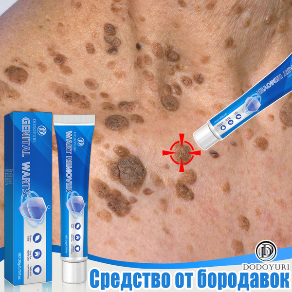 DODOYURI / Мазь от бородавок, Крем средство для удаления бородавок ...