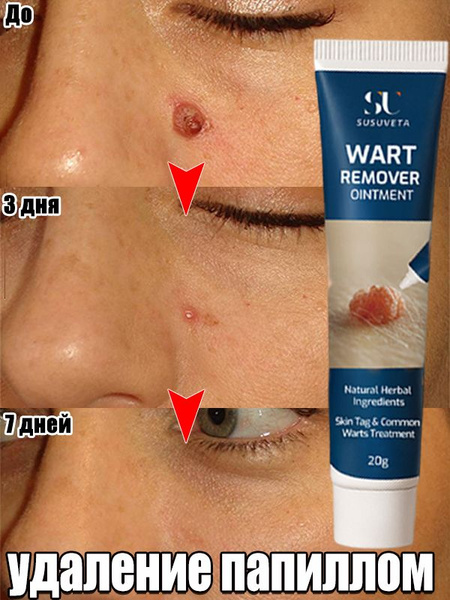 SUSUVETA / Мазь от бородавок, Крем средство для удаления бородавок ...