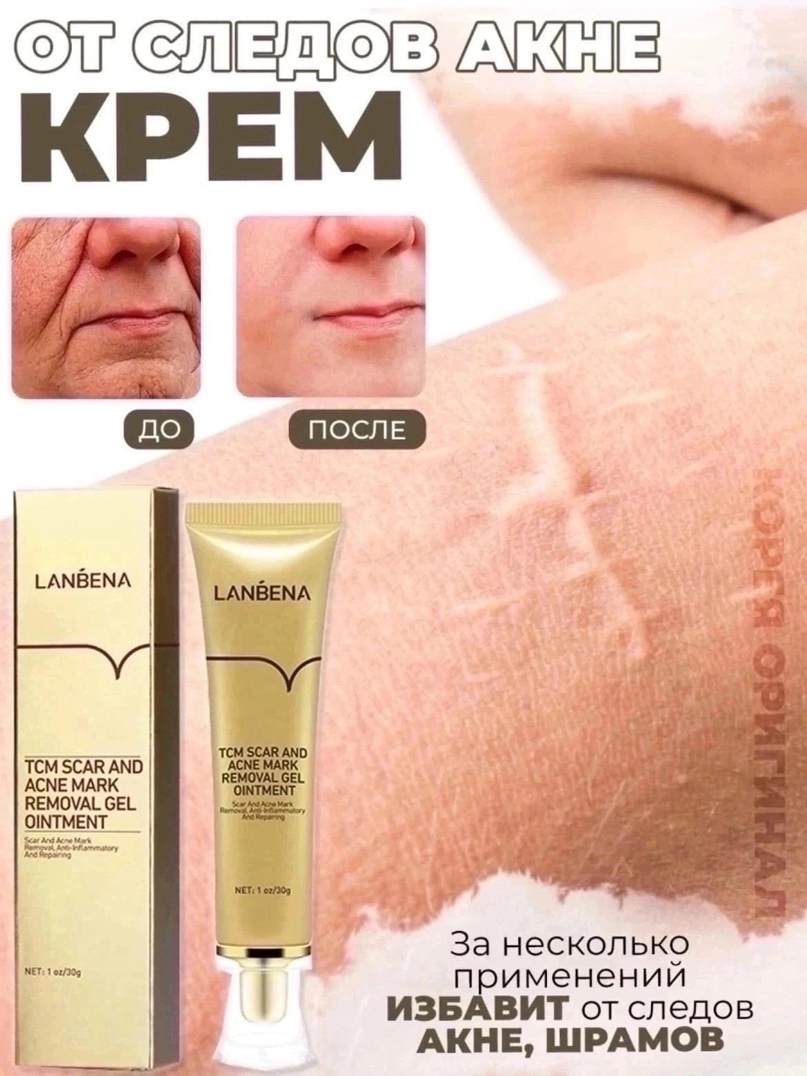 The Acne Scar Removal Cream OZON