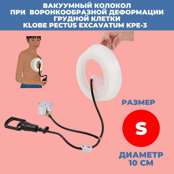 Вопросы и ответы о Вакуумный ортез (колокол) при воронкообразной ...