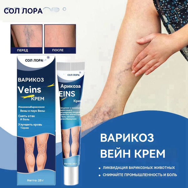 Крем от варикоза SOL LORA, для снятия боли, отека и улучшения ...