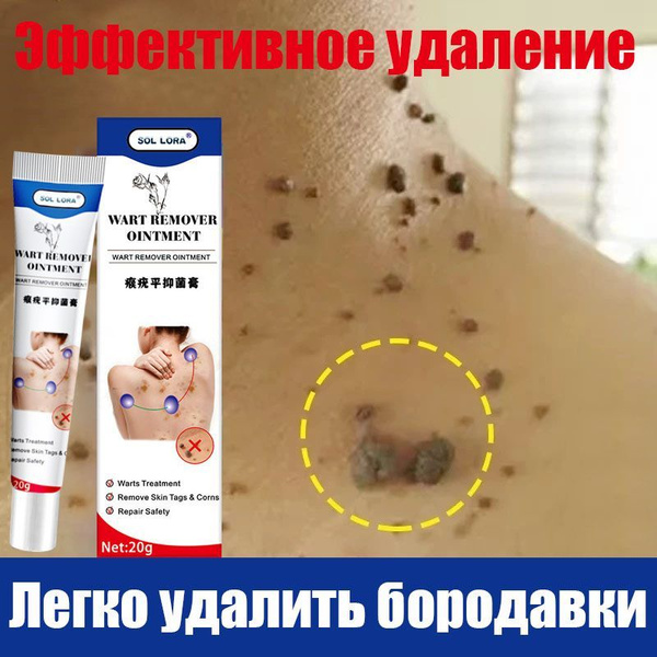 Мазь от бородавок, против генитальных бородавок, папиллом, ороговевшей ...