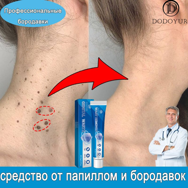 DODOYURI / Мазь от бородавок, Крем средство для удаления бородавок ...