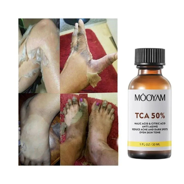 Химический пилинг TCA 50%, 7 дней Супер сильный кислотный пилинг кожи Tca, пигментация, шрамы от ...