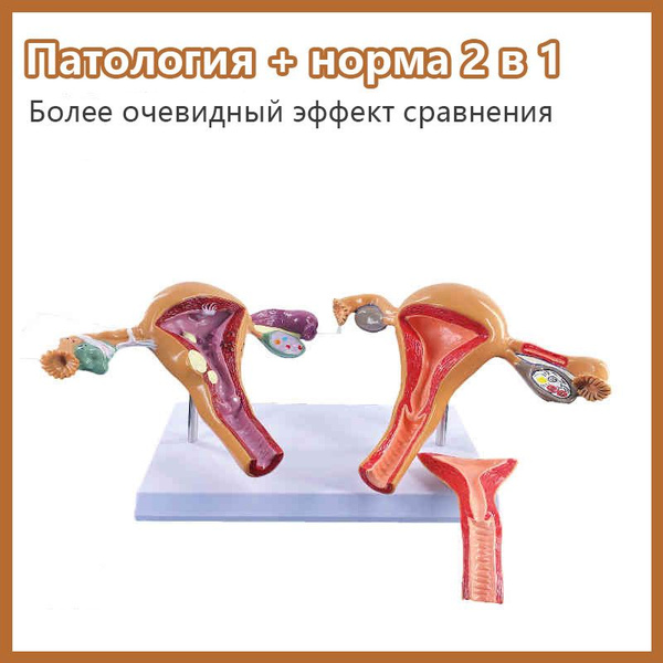 Норма + патология (комбинация) Макет "Органы матки, "Модели ...