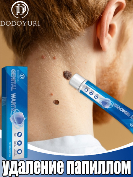 DODOYURI / Мазь от бородавок, Крем средство для удаления бородавок ...