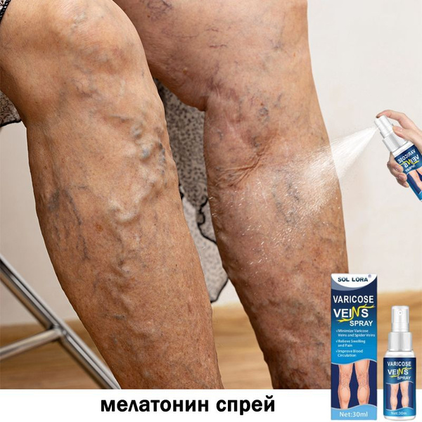 SOL LORA Спрей от варикоза, 30мл , эффективен при сосудистых звездочках ...
