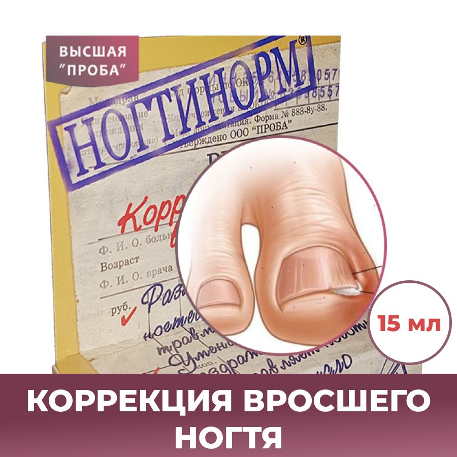 Система Коррекции Вросших Ногтей Onyclip купить на OZON по низкой цене